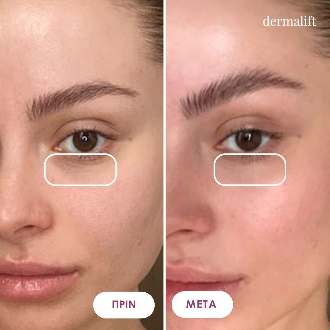 Dermalift™ Silicon Patches – dermaliftgr