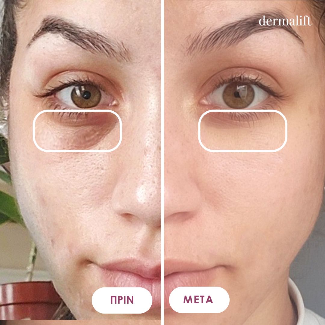 Dermalift™ Silicon Patches – dermaliftgr