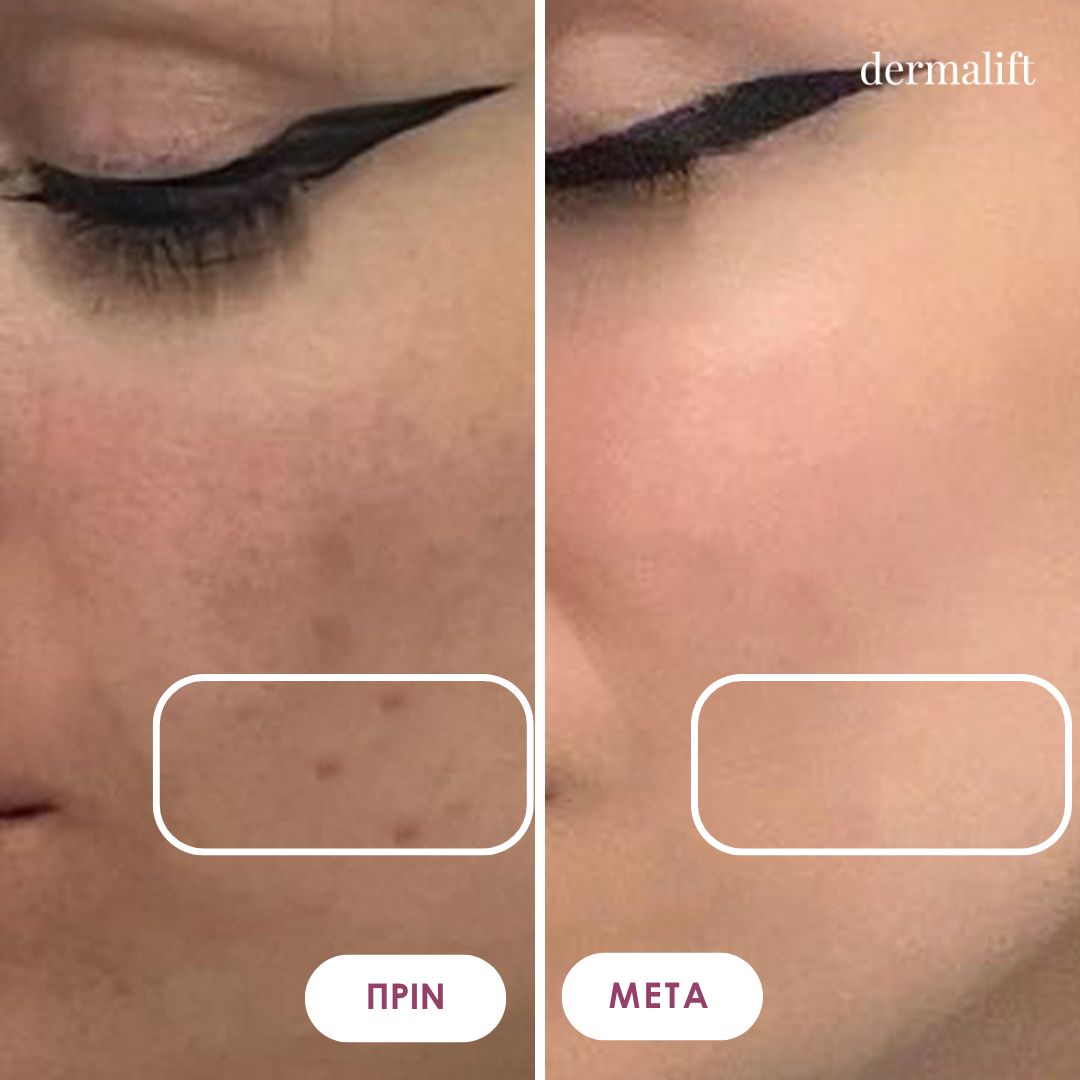 Dermalift™ Silicon Patches – dermaliftgr